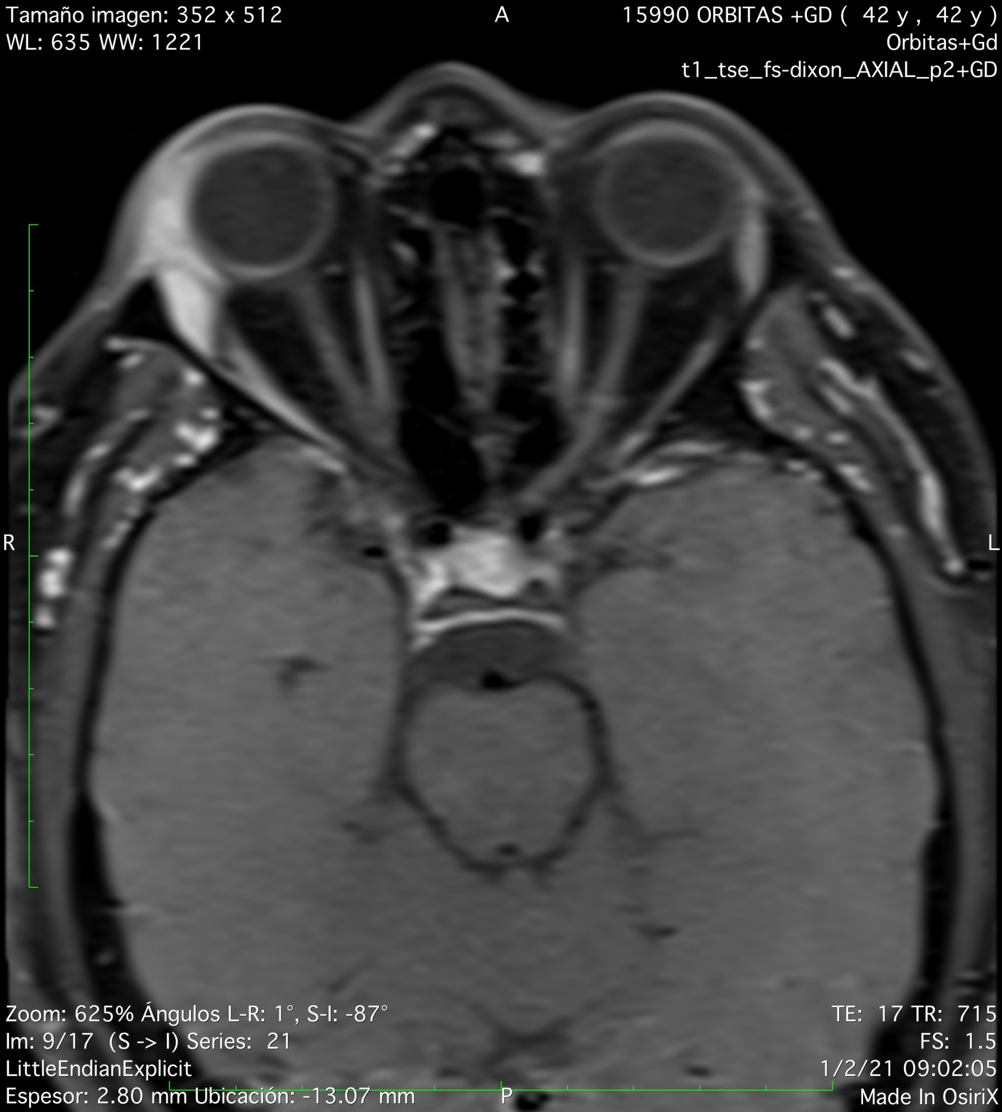 Resonancia – VAFOBOL